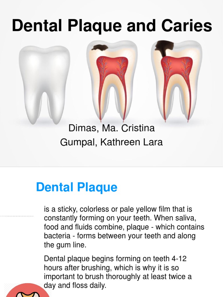Understanding Dental Plaque, Tooth Decay, and Caries: Causes, Risk ...