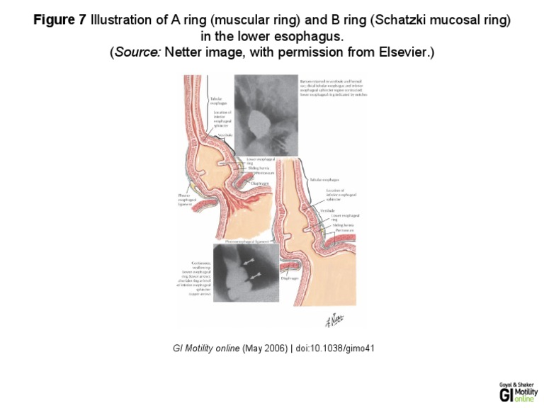 Özefagus (Esophagus) Schatzki Ring | PDF