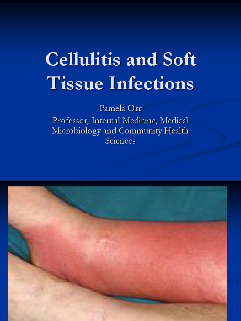 Cellulitis and Soft Tissue Infections | PDF