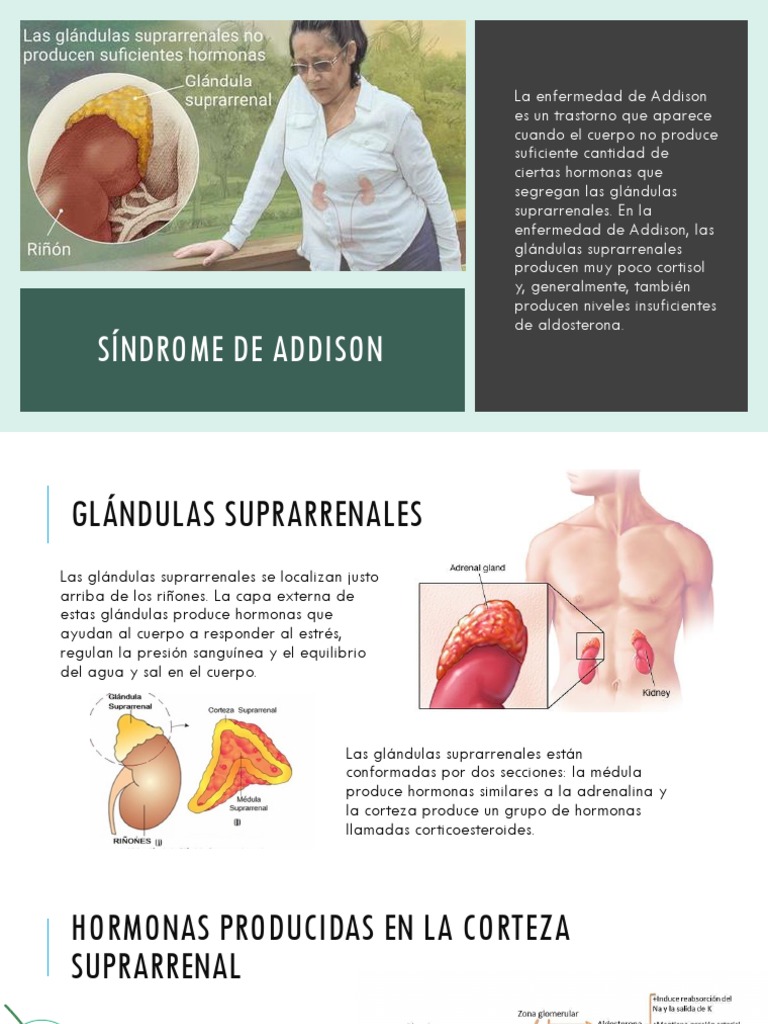 Síndrome de Addison | PDF | Glándula suprarrenal | Medicina CLINICA