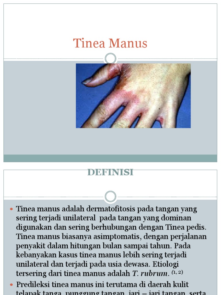 Tinea Manus | PDF