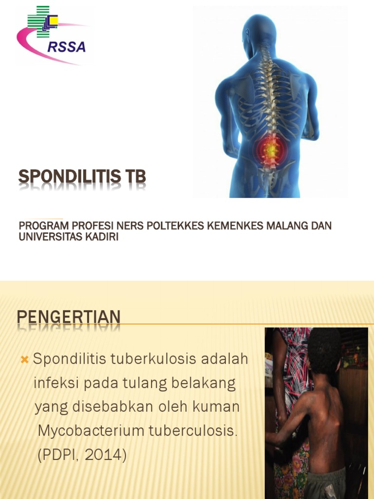Spondilitis TB | PDF