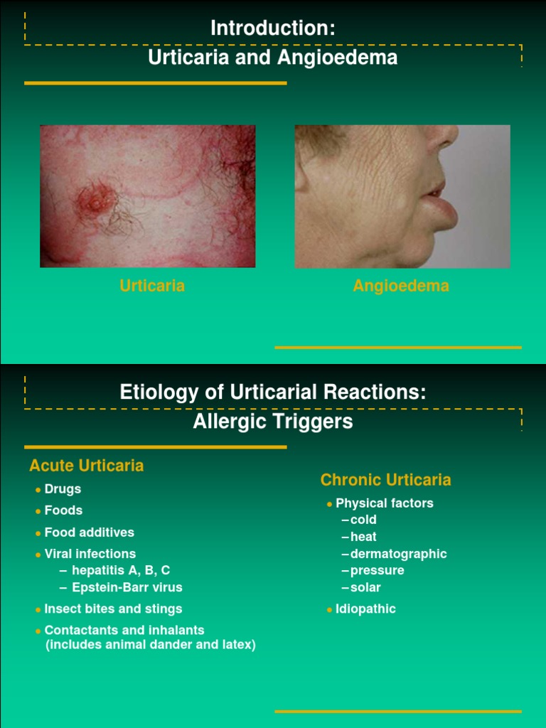 Urticaria and Angioedema | PDF | Allergy | Immunology