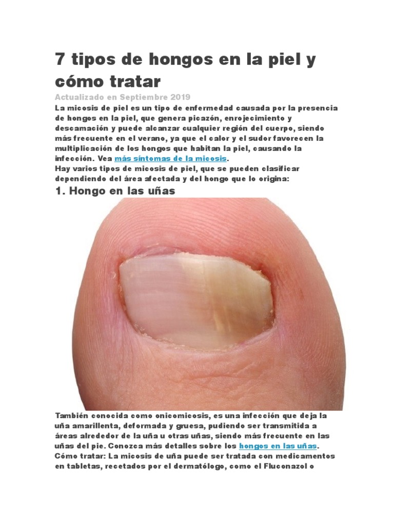 7 Tipos de Hongos en La Piel y Cómo Tratar | PDF | Candidiasis | Clavo ...