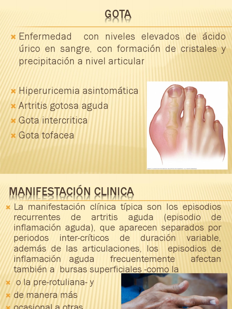 Comprensión integral de la gota: manifestaciones clínicas, diagnóstico ...