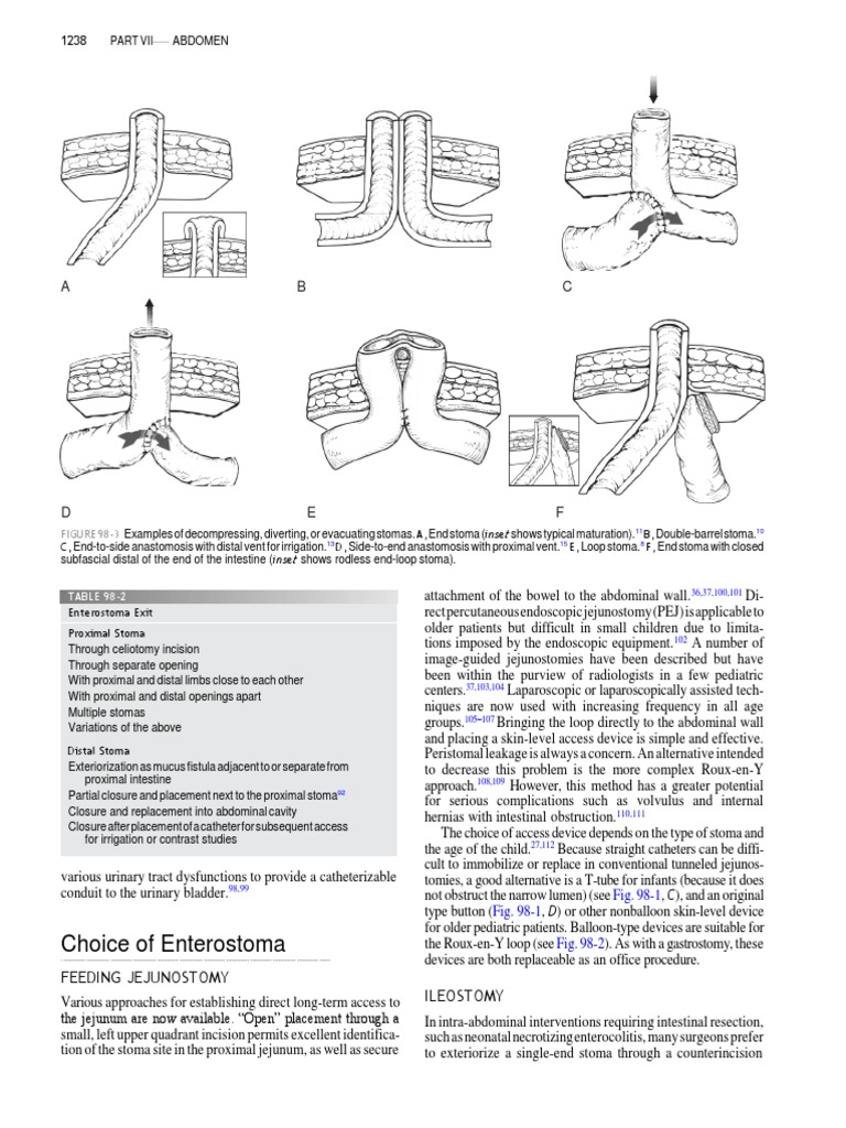 Double Barrel Ileostomy