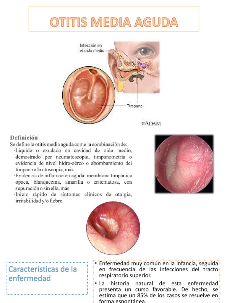 Diagnóstico y Tratamiento de Otitis Media Aguda | PDF | Alergia ...