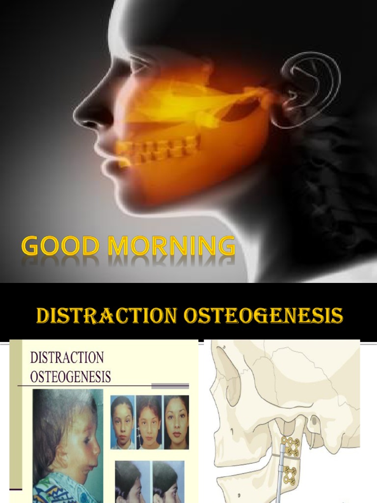 Distraction Osteogenesis | PDF | Face | Human Anatomy