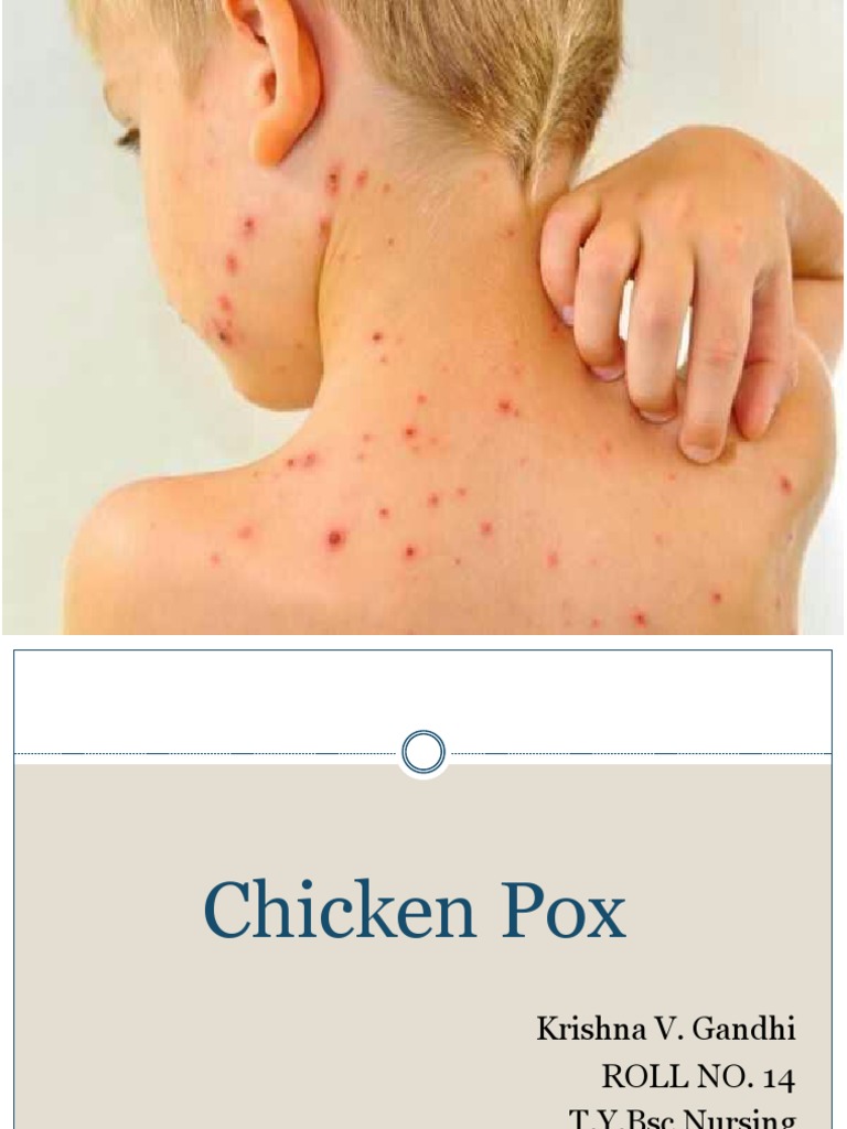 Chicken Pox Pdf Virology Rtt
