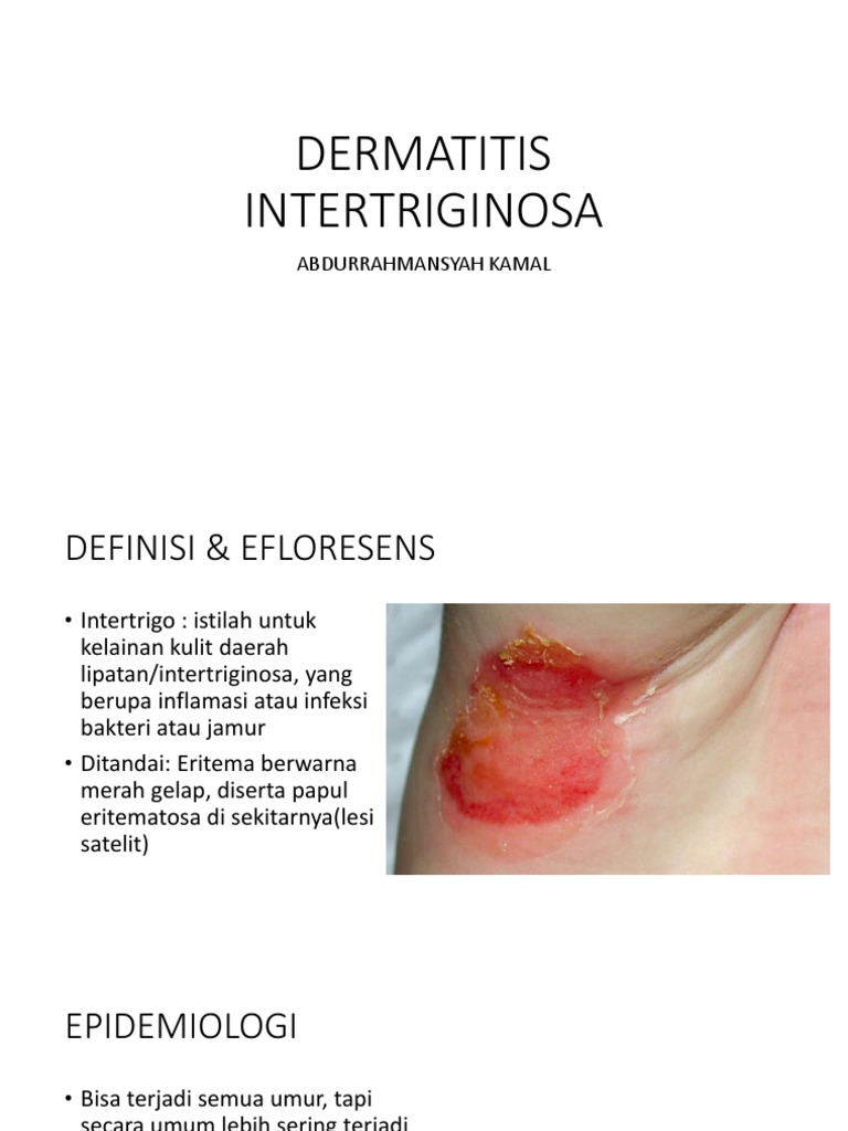 Dermatitis Intertriginosa | PDF