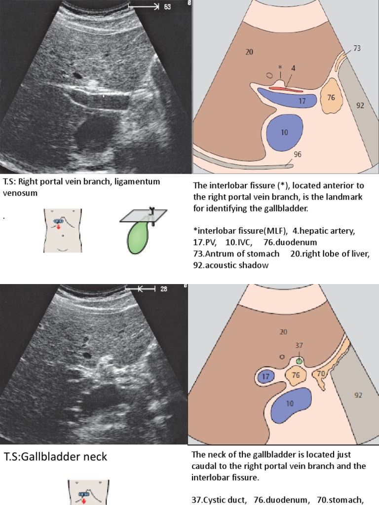Anatomy and Ultrasound Imaging of the Biliary System: A Reference for ...
