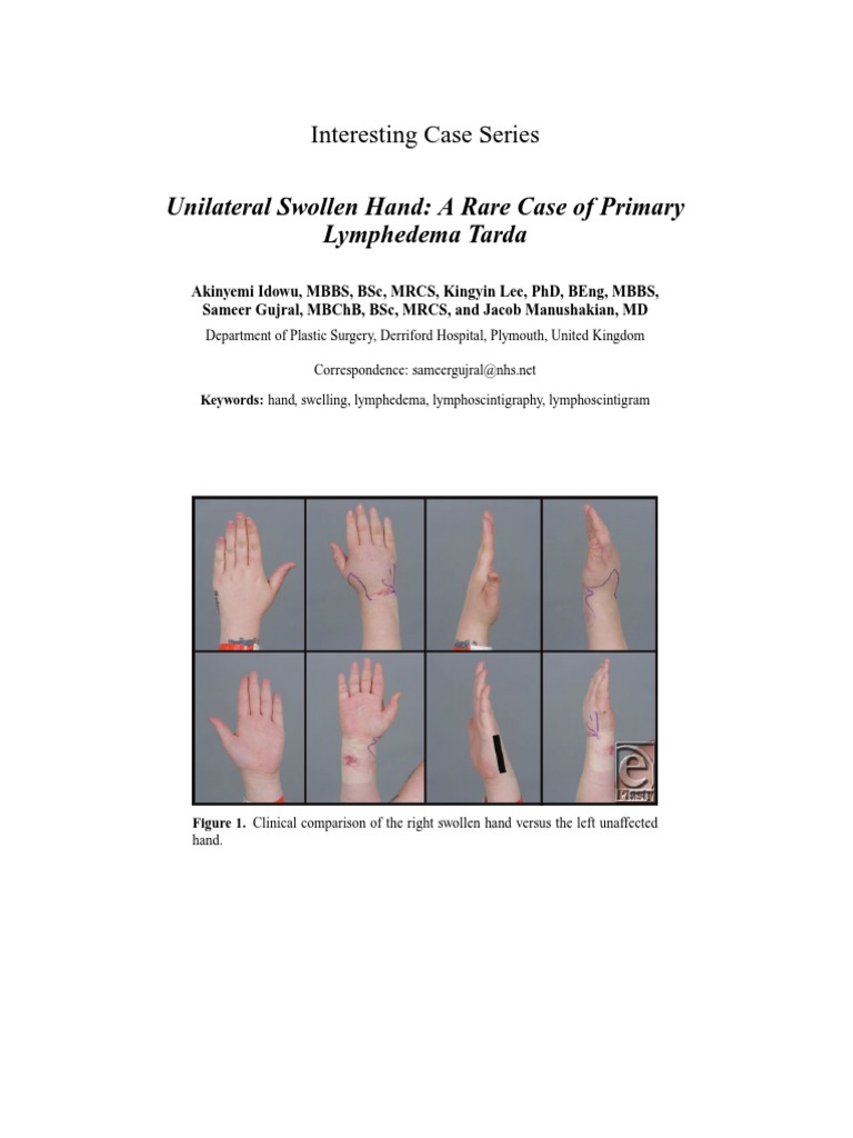 Unilateral Swollen Hand: A Rare Case of Primary Lymphedema Tarda | PDF ...