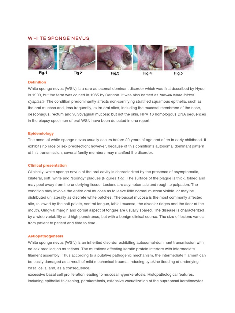 White Sponge Nevus | PDF | Epidemiology | Health Sciences