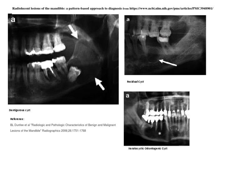 Gambaran Radiografi Kista | PDF