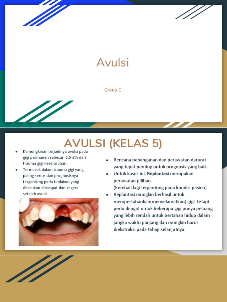 Trauma Gigi Pada Anak Kelas V (Avulsi) | PDF