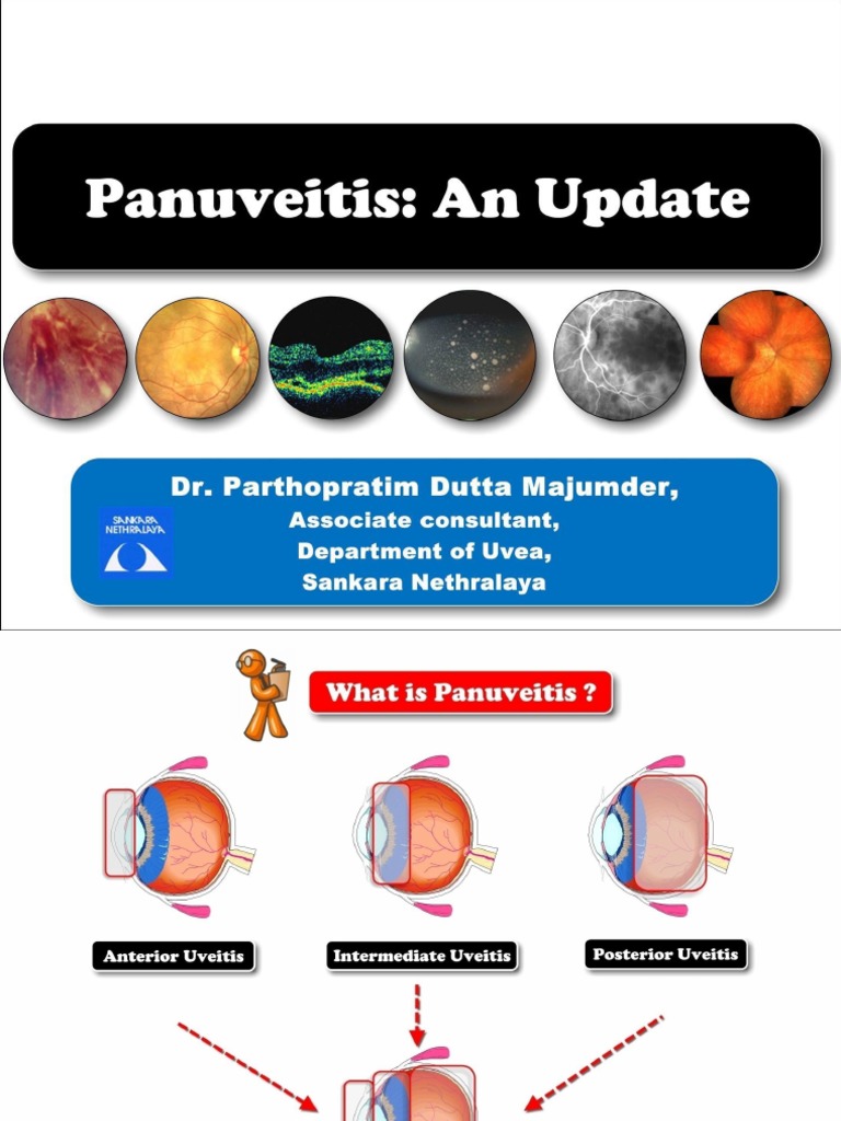 Panuveitis