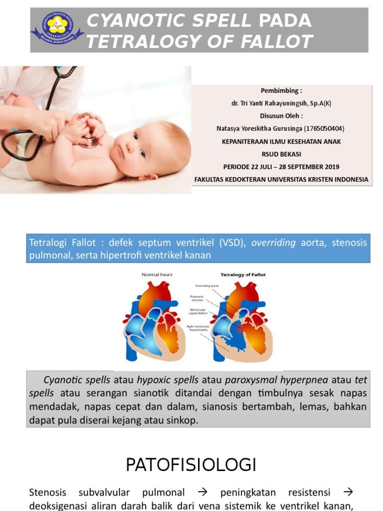 Cyanotic Spell Pada Tetralogy of Fallot | PDF