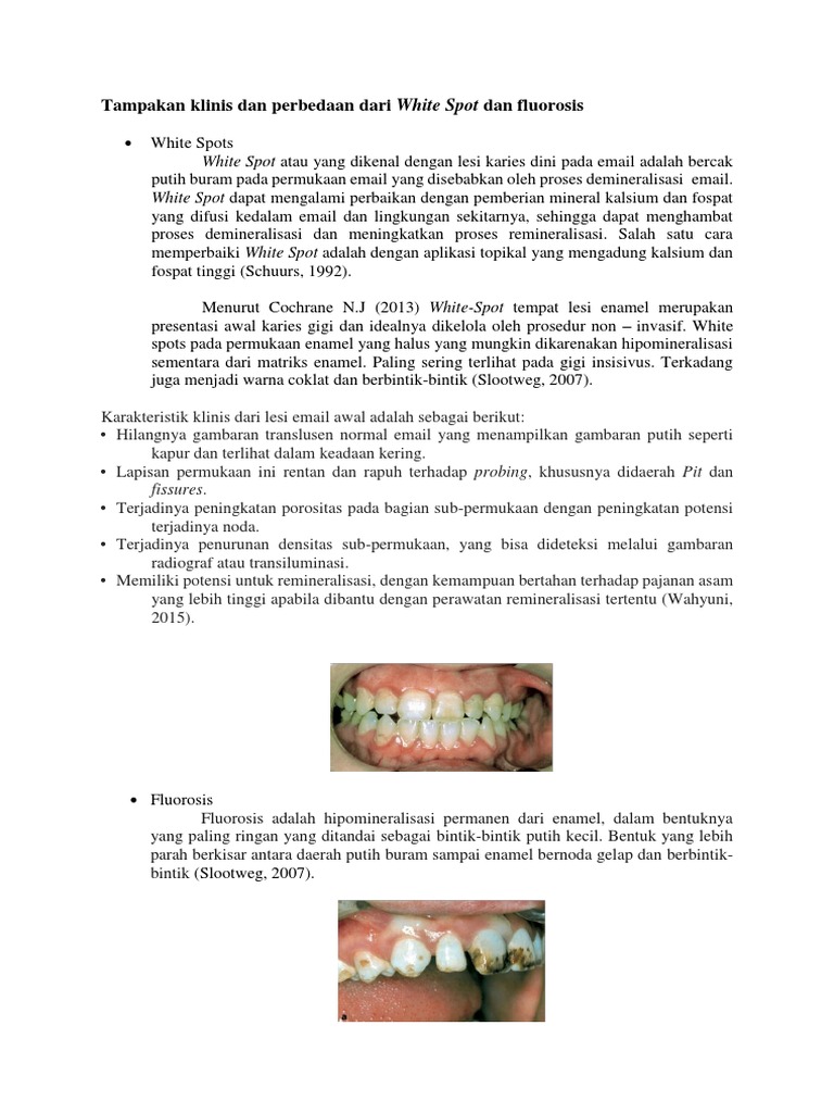 Perbedaan White Spot Dan Fluorosis | PDF