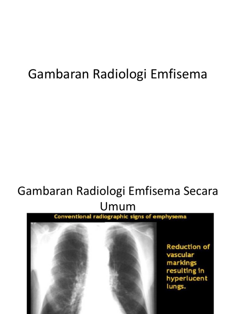 Gambaran Radiologi Emfisema | PDF