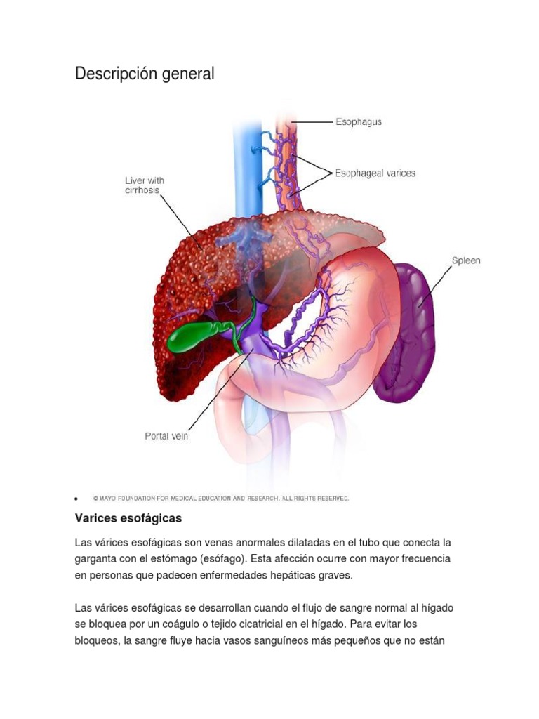 Varices esofágicas y cirrosis hepática | PDF | Cirrosis | Hígado