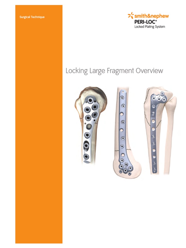 Smith & Nephew Periloc Large Fragment Plate | PDF | Drill | Screw