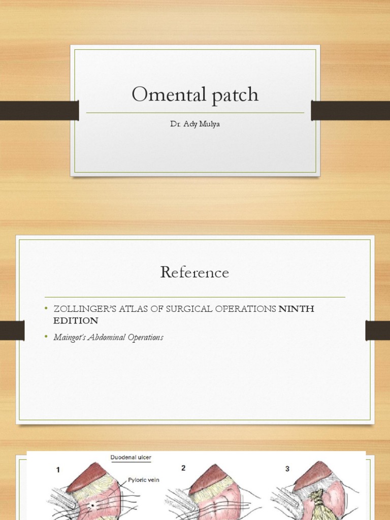 Omental Patch | PDF