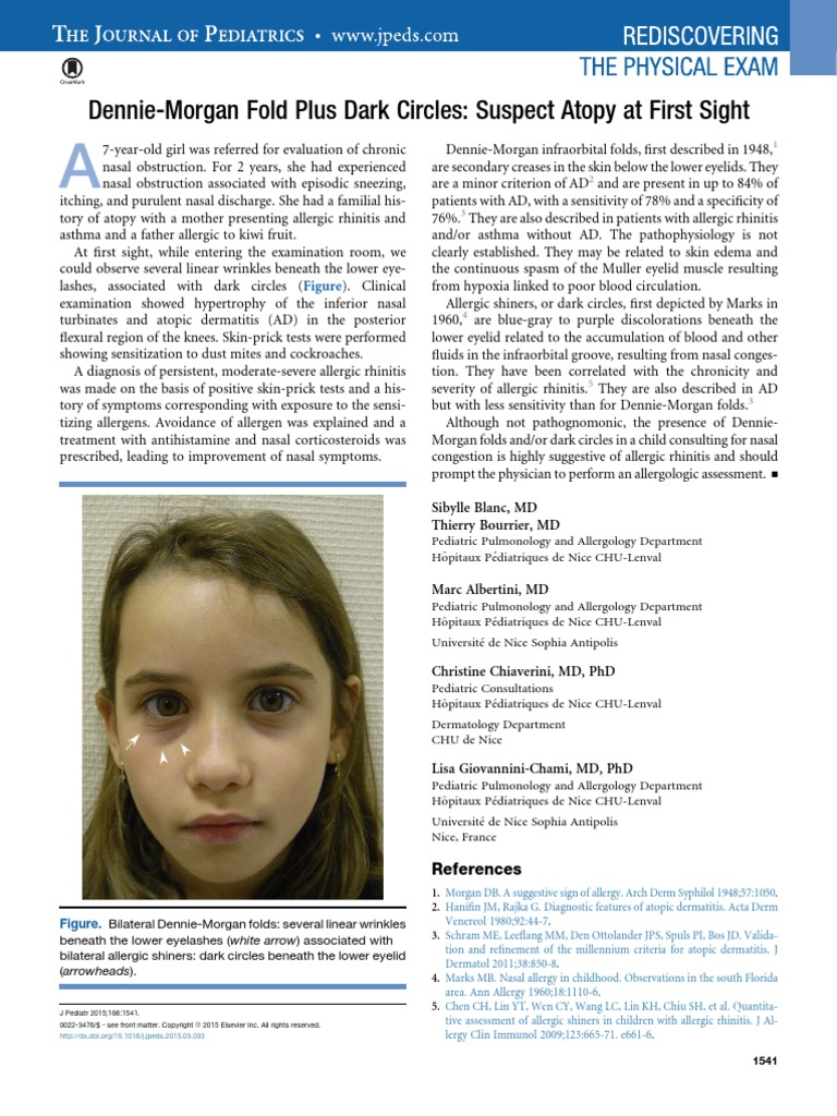 Dennie-Morgan Fold Plus Dark Circles: Suspect Atopy at First Sight ...