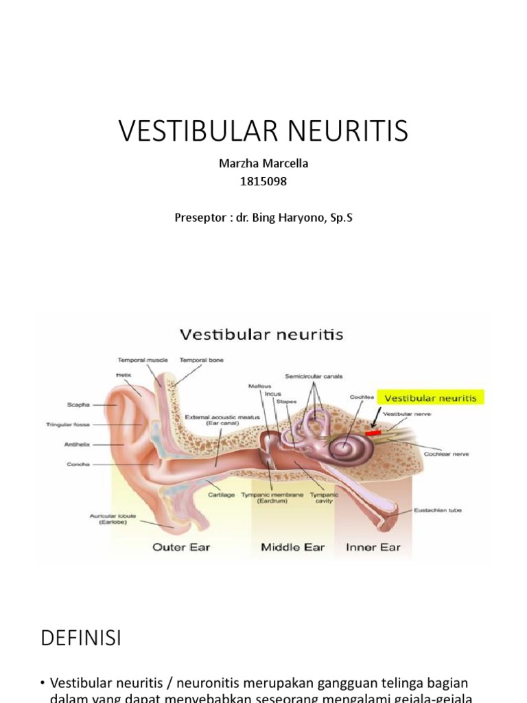 Vestibular Neuritis Pdf