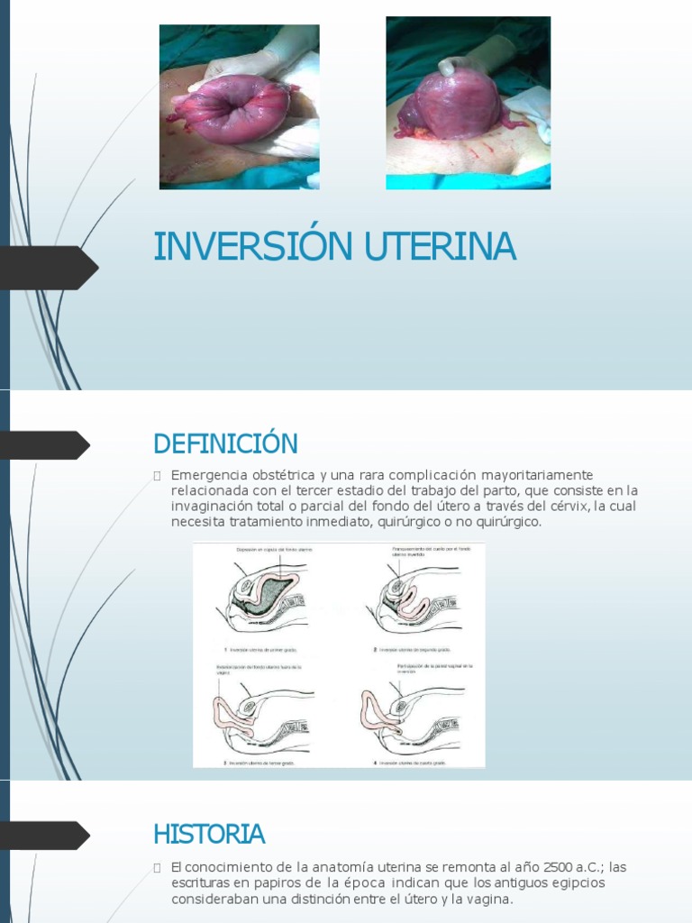 Inversion Uterina | PDF | Útero | Parto