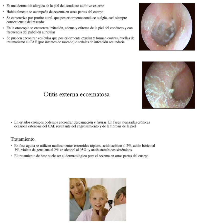 Otitis Externa Eccematosa: Guía Clínica | PDF