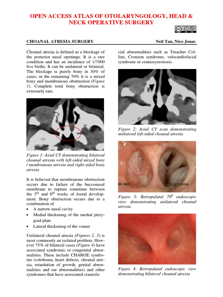 Choanal Atresia | PDF | Human Nose | Otorhinolaryngology