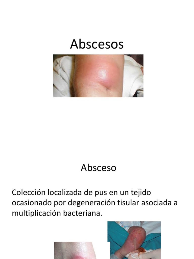 Abscesos: Causas, Diagnóstico y Tratamiento | PDF | Rtt | Medicina CLINICA