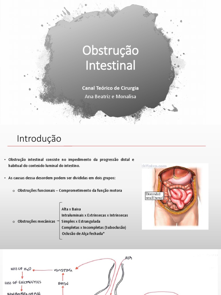 Obstrução Intestinal: Causas e Tratamento | PDF | Dor | Intestino delgado