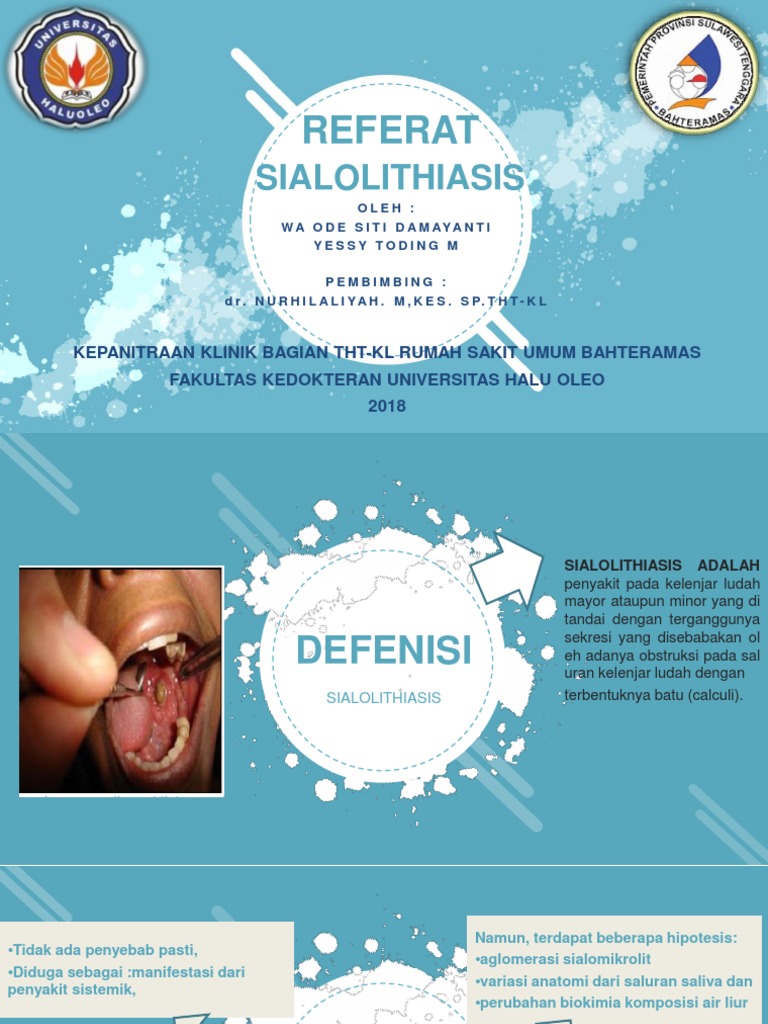 Sialolithiasis | PDF