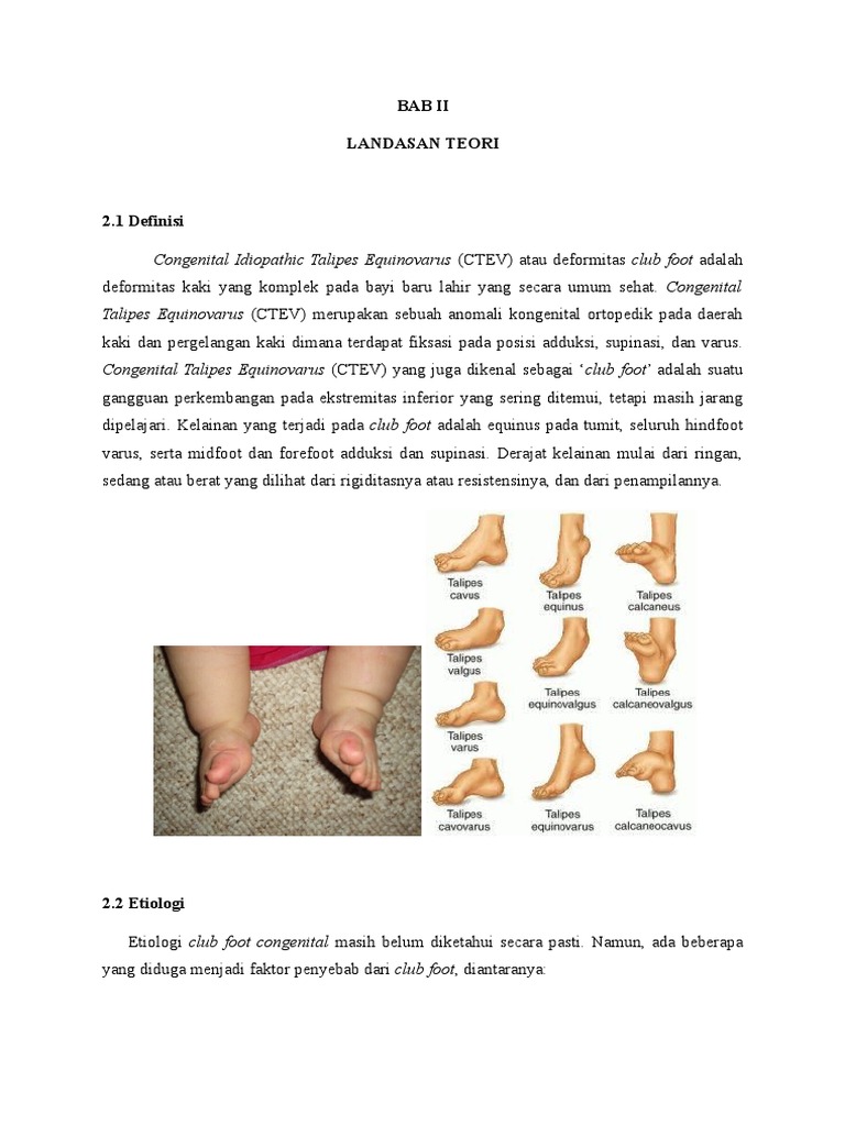 Bab 2 Club Foot | PDF