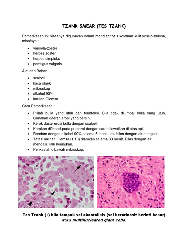 Pemeriksaan Tzank untuk Diagnosa Herpes | PDF