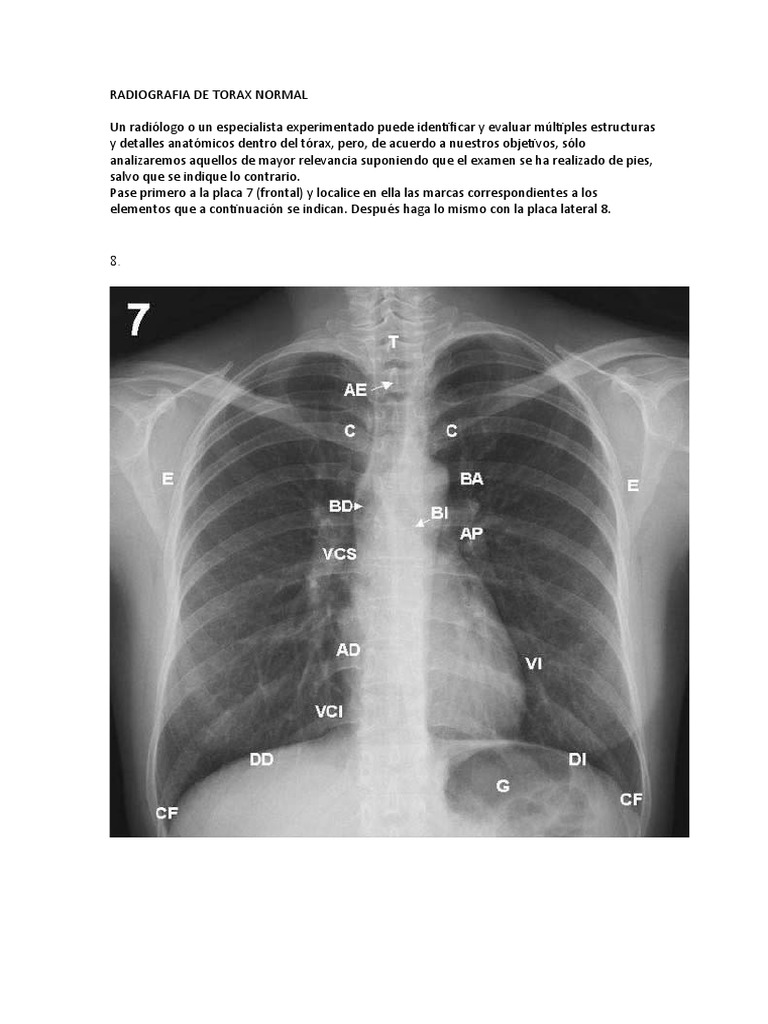 RX Torax Normal | PDF | Pulmón | Tórax