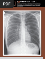 Chest X-Ray Interpretation | PDF | Lung | Thorax