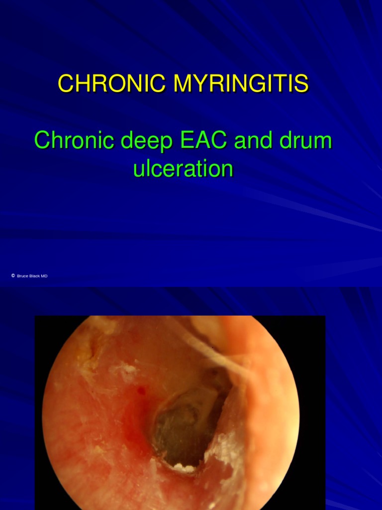 Chronic Myringitis Management Strategies | PDF | Otology | Human Head ...