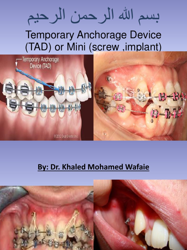 Temporary Anchorage Devices | PDF | Dental Implant | Orthodontics
