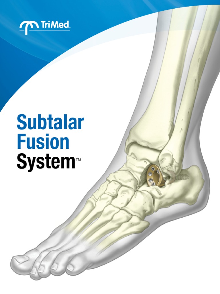 System Brochure - Subtalar Fusion Cup PDF | PDF | Industrial Processes ...