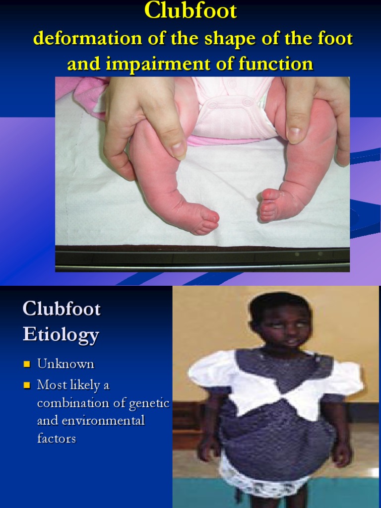 Clubfoot | PDF | Foot | Human Leg