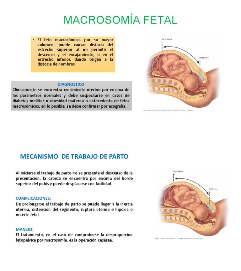 Macrosomía Fetal | PDF