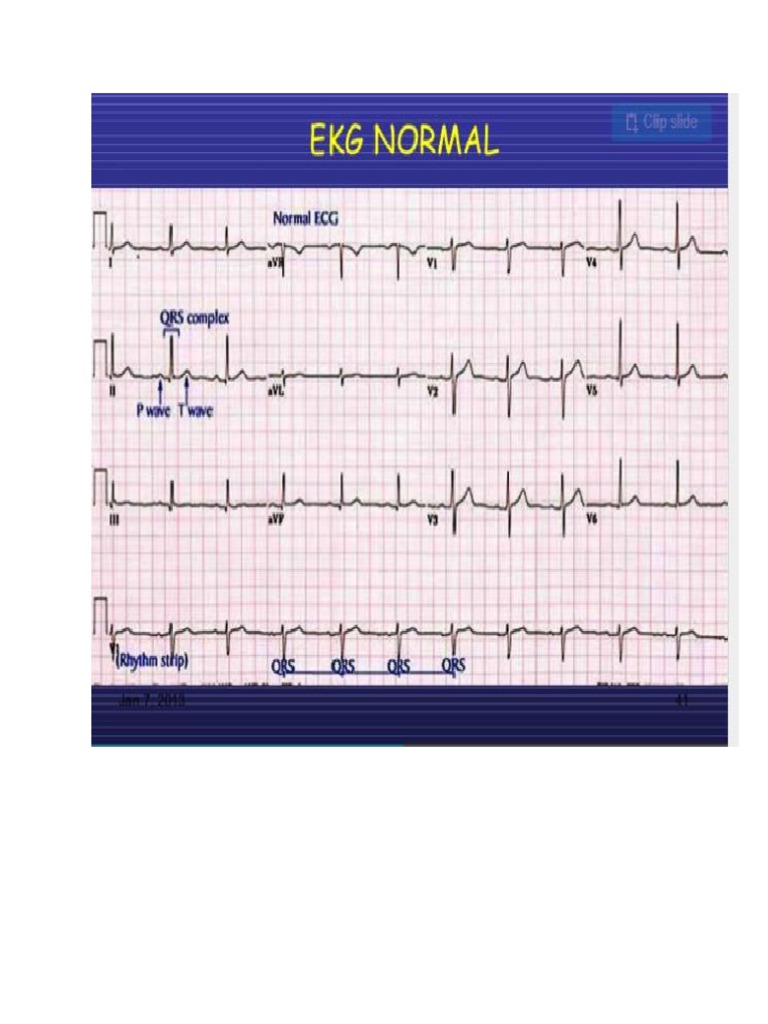 Ekg Normal | PDF