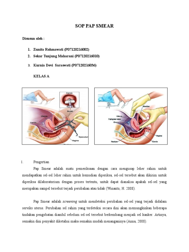 Sop Pemeriksaan Pap Smear | PDF