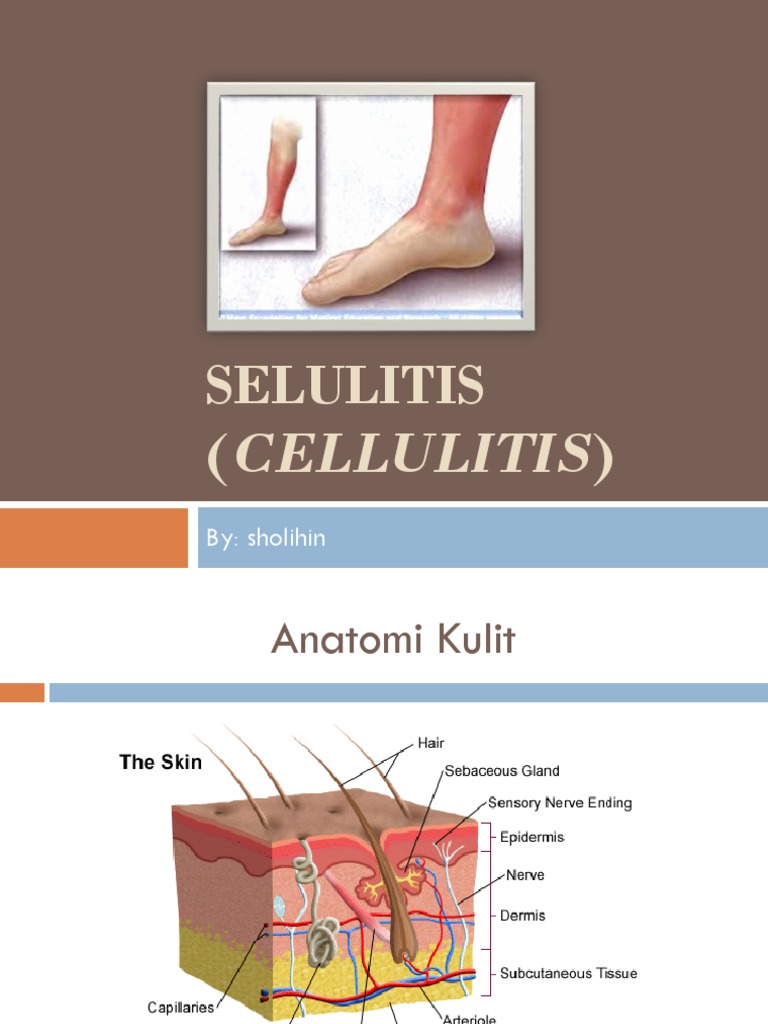 Selulitis | PDF