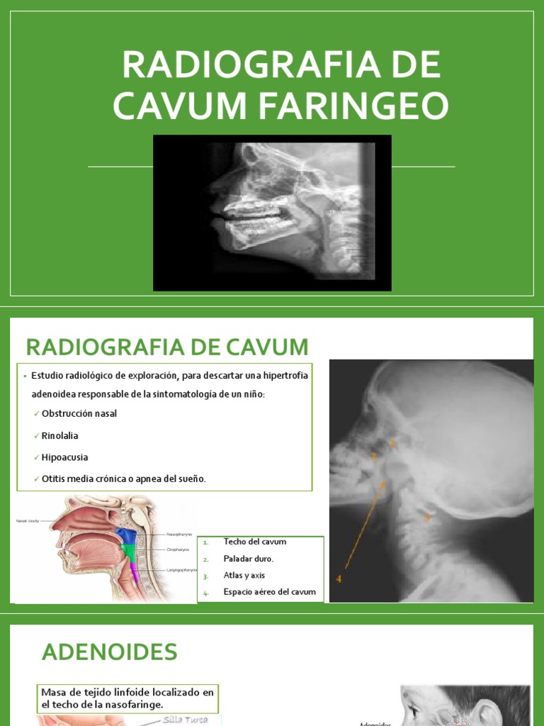 Radiografía del Cavum Faríngeo en Niños | PDF | Articulación | Sistema ...