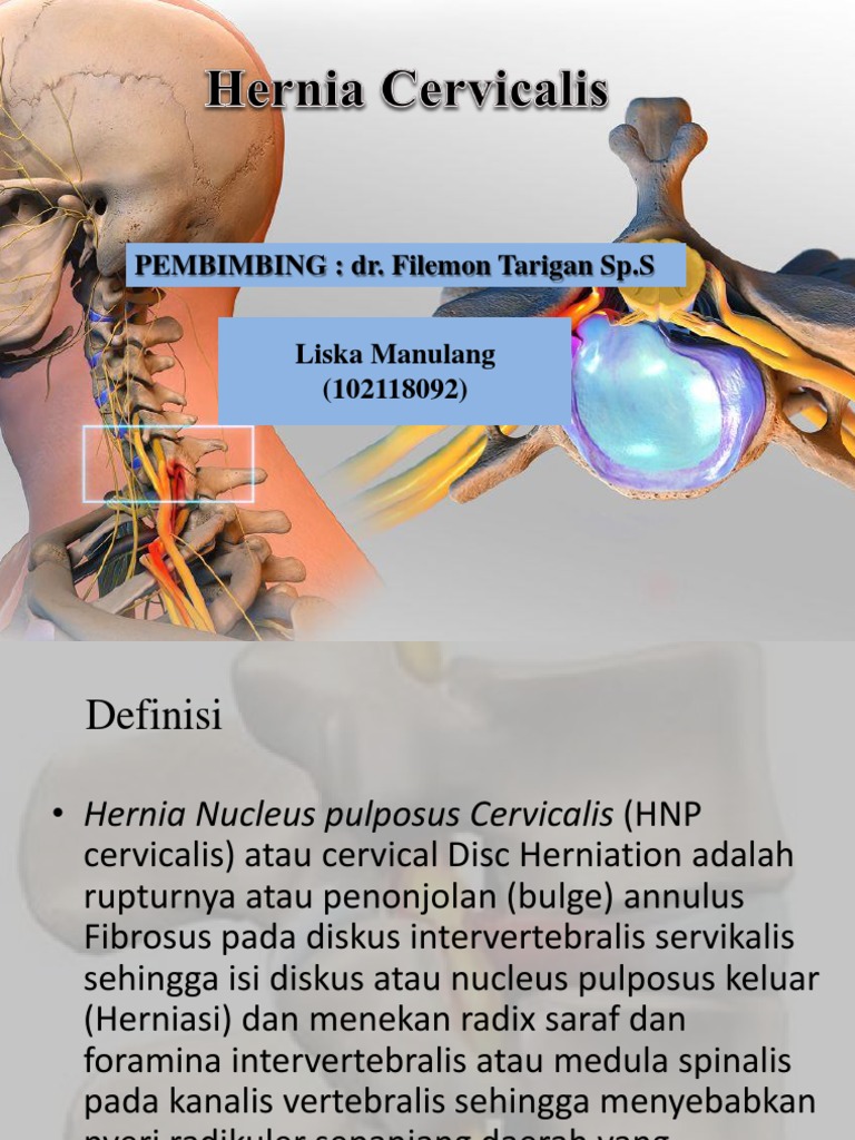 HNP Cervical | PDF