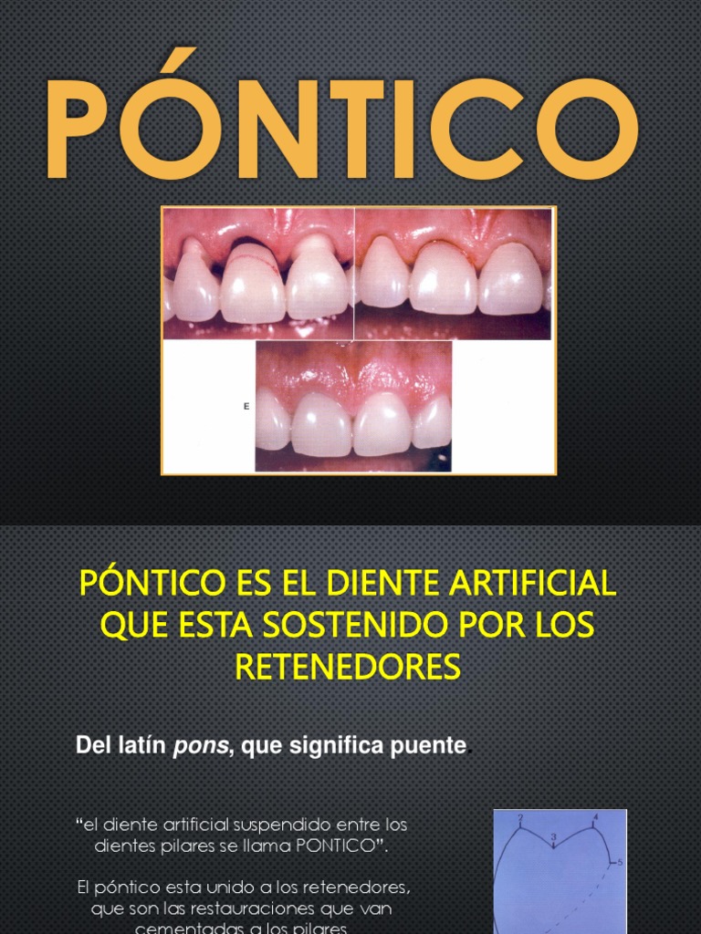Tipos y Diseño de Pónticos Dentales | PDF | Dentadura postiza | Odontología