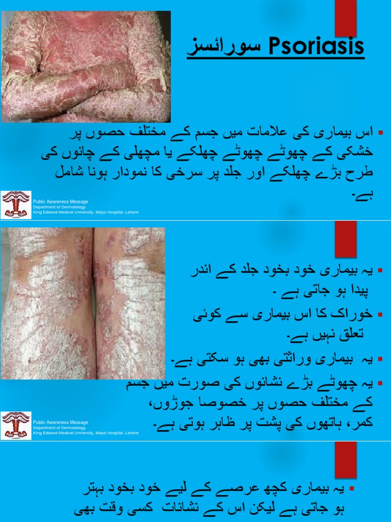 Psoriasis PPT Final Modified | PDF